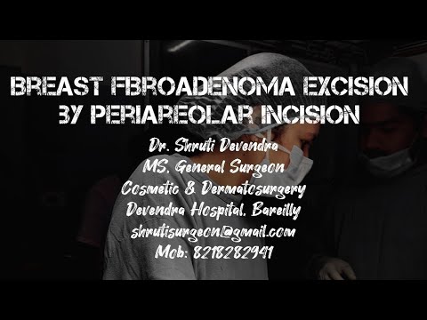 Breast Fibroadenoma excision via periareolar incision - cosmetic ...