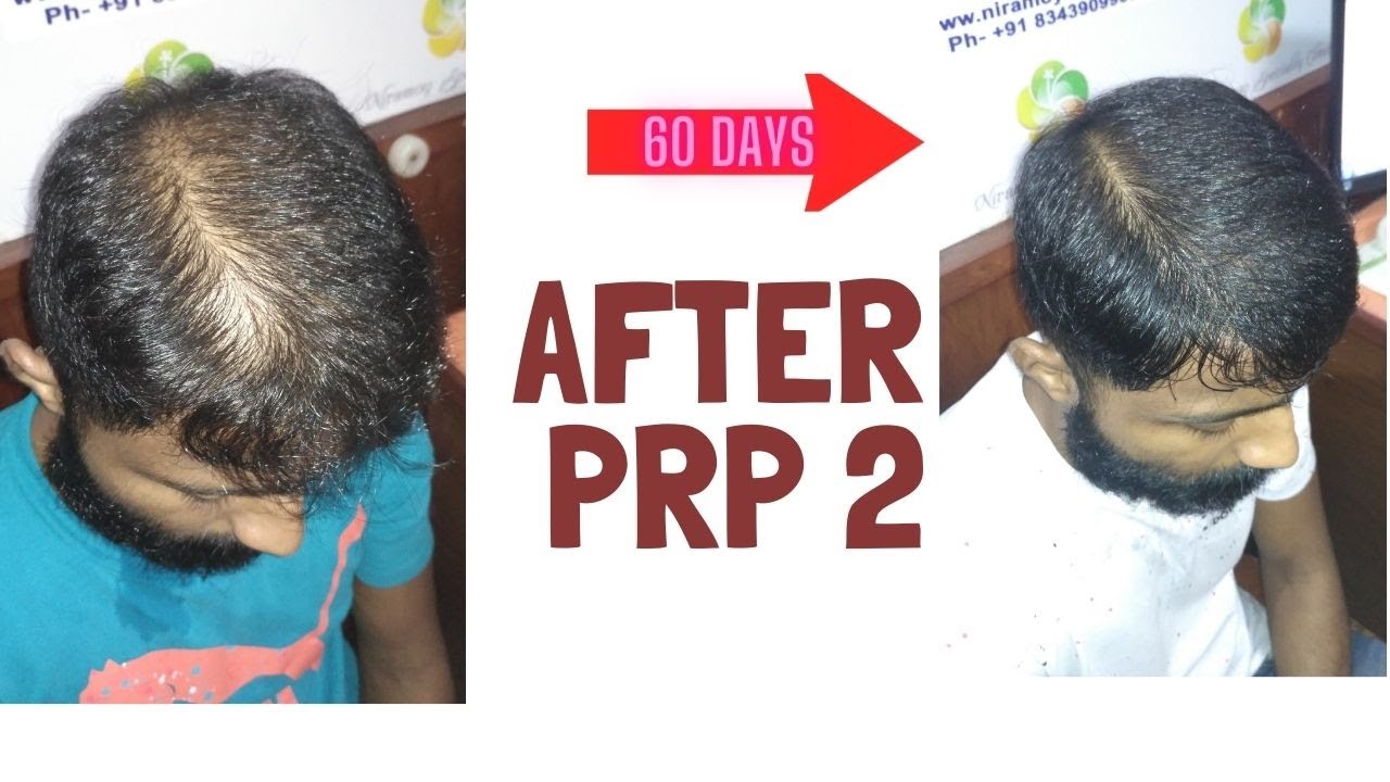 PRP 2 Months Results | 100% Feedback | Hair Fall Treatment - YouTube