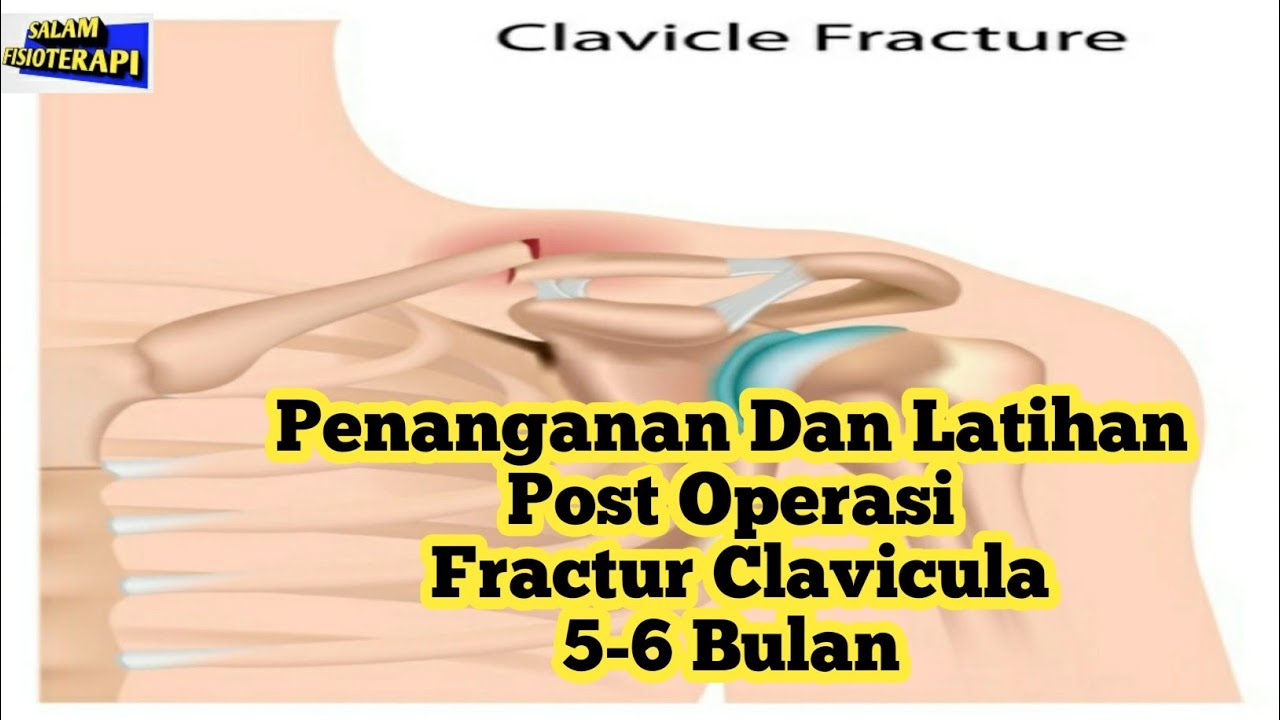 Fisioterapi-Penanganan dan Latihan Pada Fraktur Post Operasi Calvicula ...