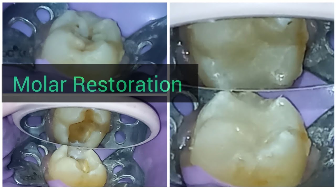 Tooth Decay Removal Procedure | How a Molar Filling is done ...