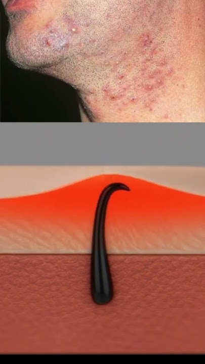 Stop Ingrown Hairs The Root Cause Explained Youtube