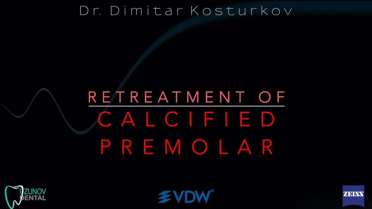 Endodontic retreatment of calcified upper premolar with VDW.Rotate ...