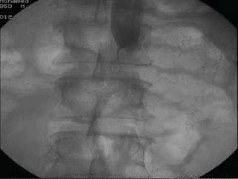 TASC D AORTOILIAC OCCLUSION - YouTube