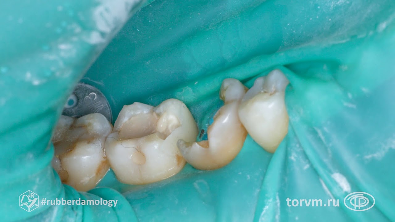 #rubberdamology TorVM Matrix Aplication 002 ENG - YouTube