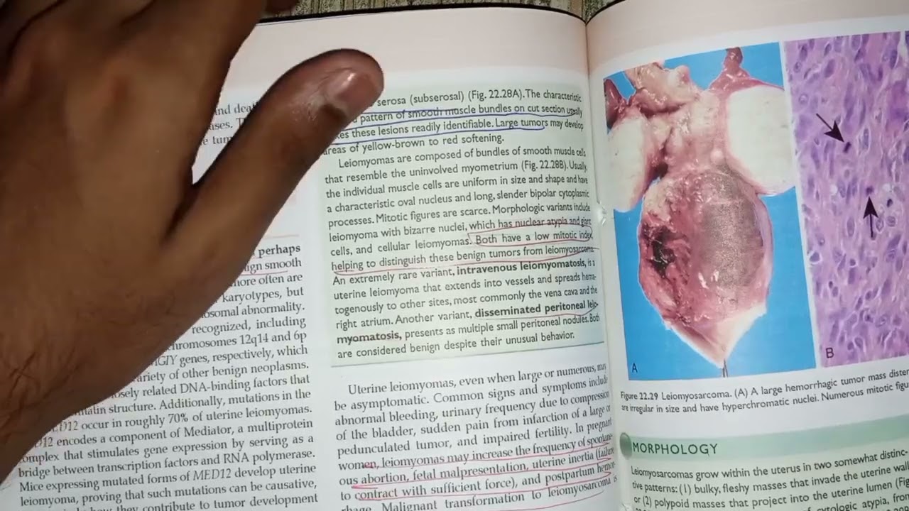 morphology of female genital tract part 2/2 - YouTube