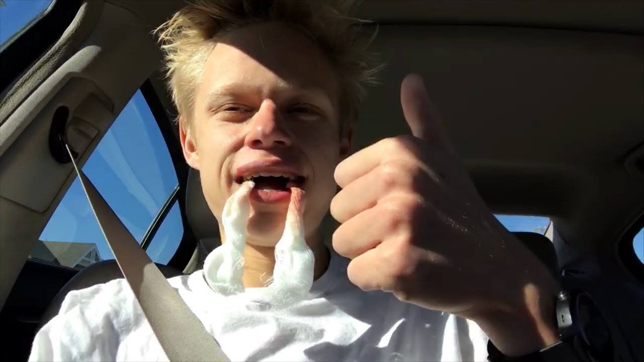 FUNNY WISDOM TEETH REMOVAL AFTERMATH - YouTube