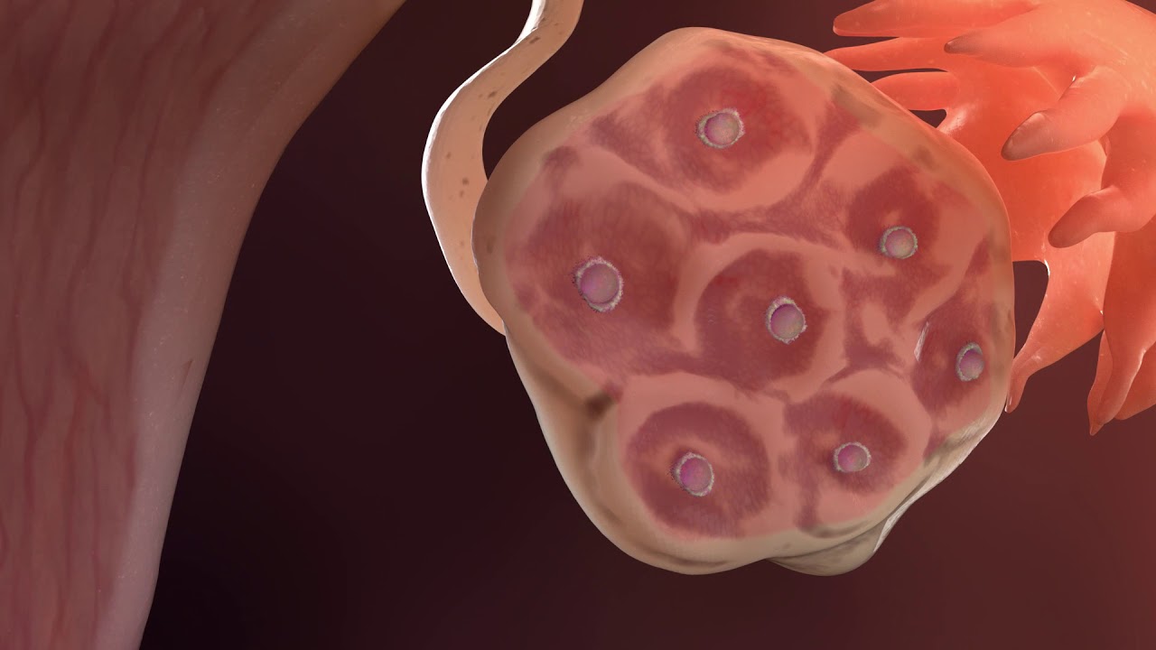 Estimulación folicular y punción ovárica - YouTube