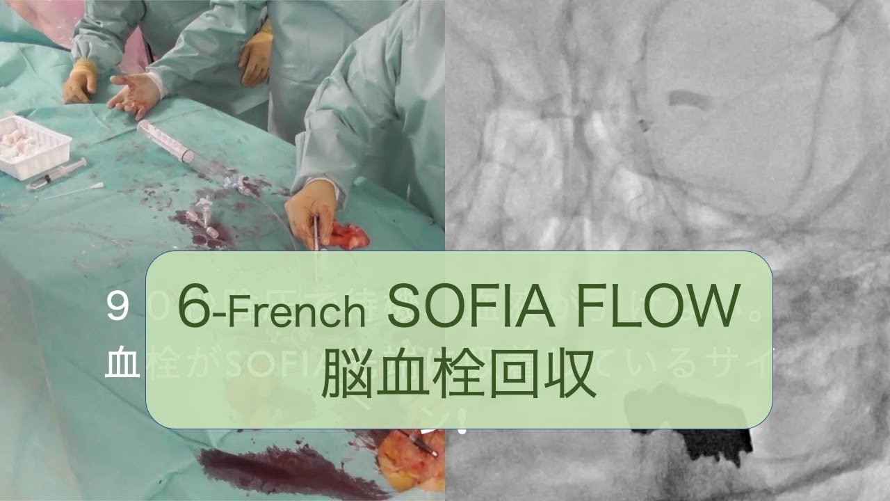 SOFIA FLOW吸引カテによる脳血栓回収 - YouTube