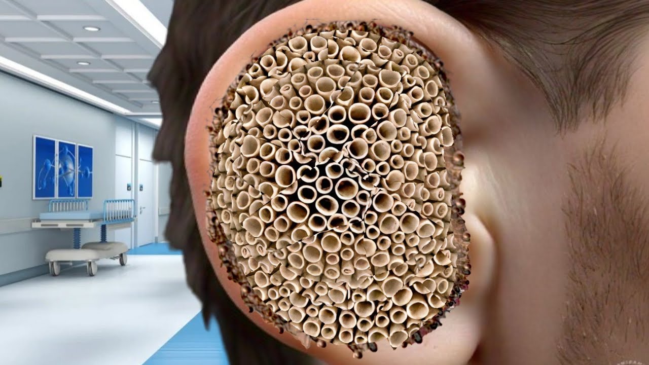 ASMR phobia beetle infected ear | ASMR severely improved ear treatment ...