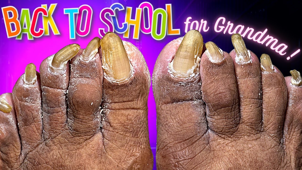 Back To School For Grandma: Trimming Long, Thick, Fungal Toenails - YouTube