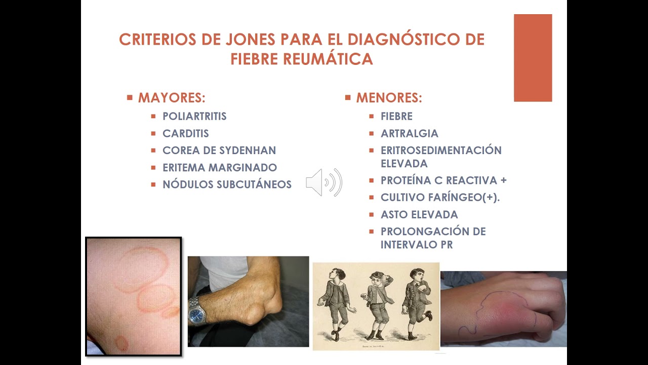 Endocarditis y Fiebre Reumática - YouTube