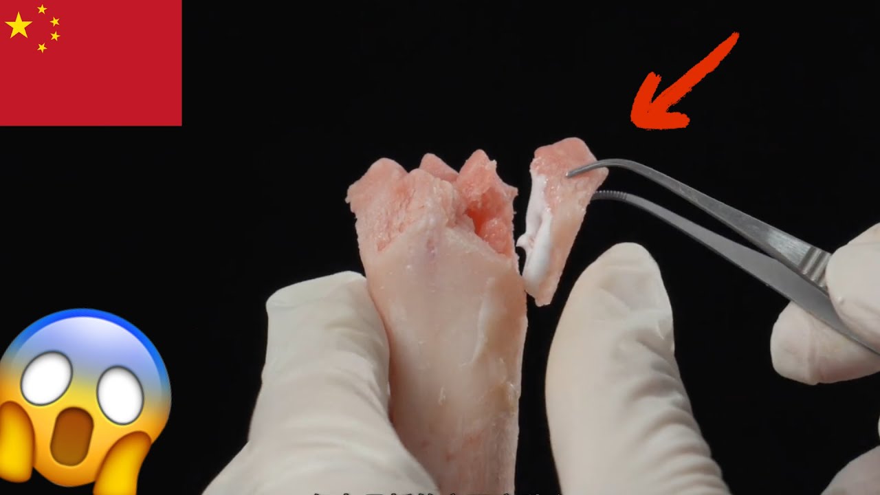 CHINA has invented a new Bone Glue that repairs bone fractures in just ...