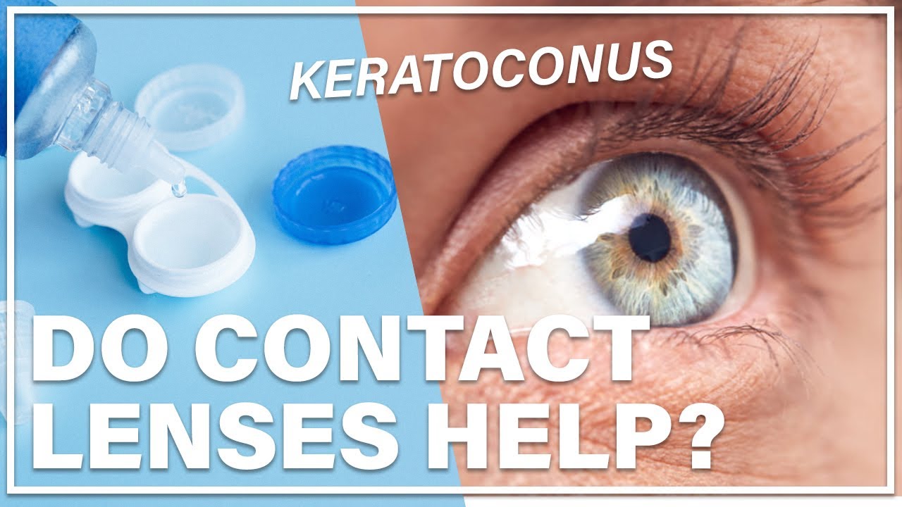 Keratoconus Contact Lenses