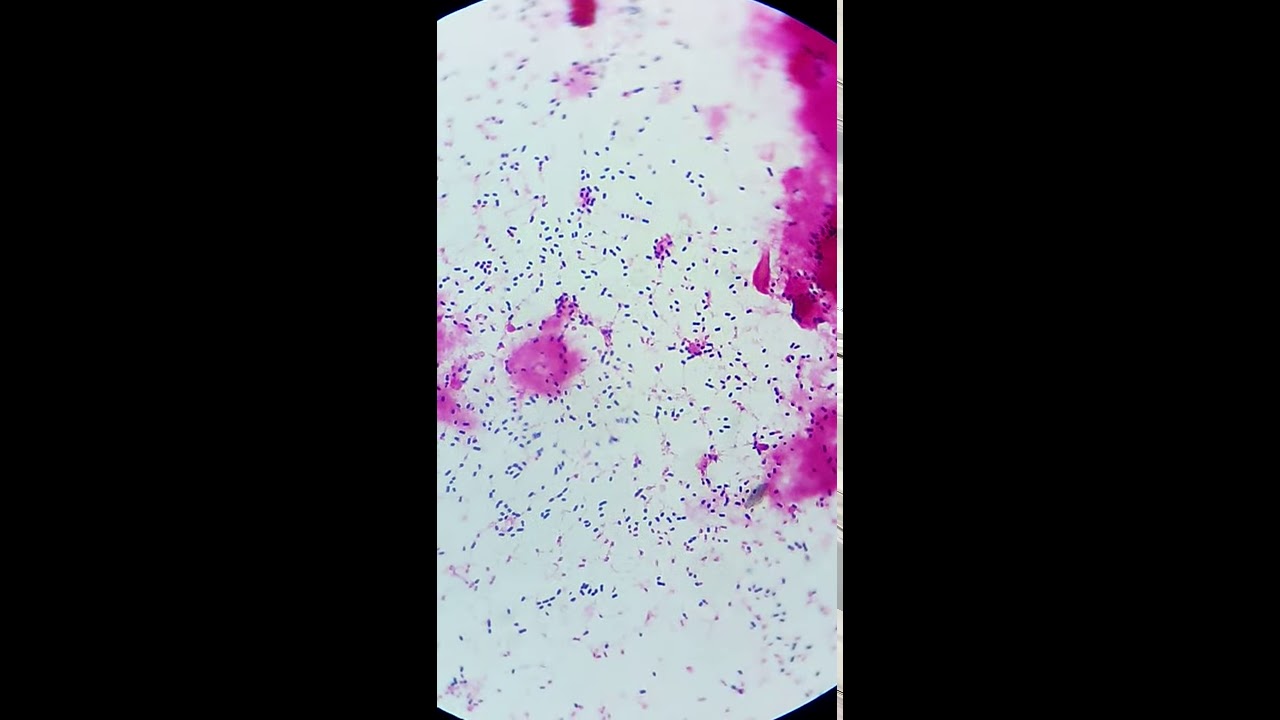 Diplocoque gram positif en faveur de Pneumocoque - YouTube