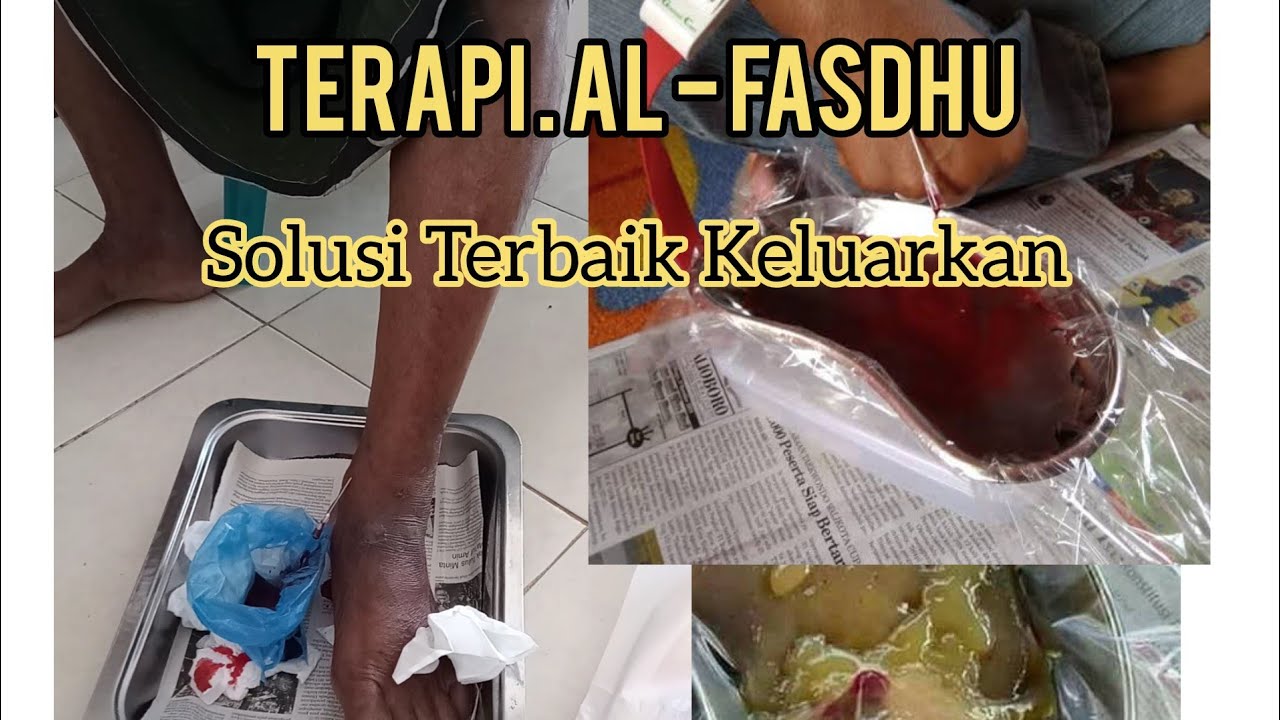 Terapi Al Fasdhu Nagan Raya Part #01 - YouTube
