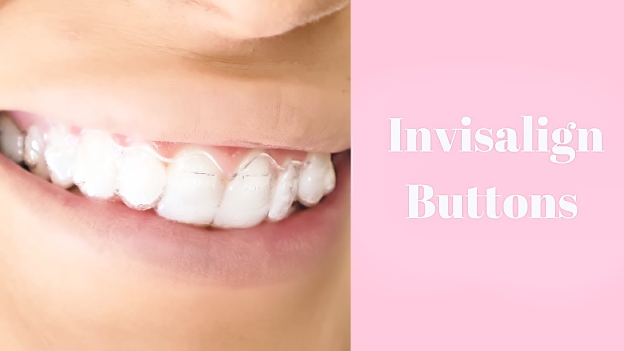 GETTING INVISALIGN ATTATCHMENTS - YouTube