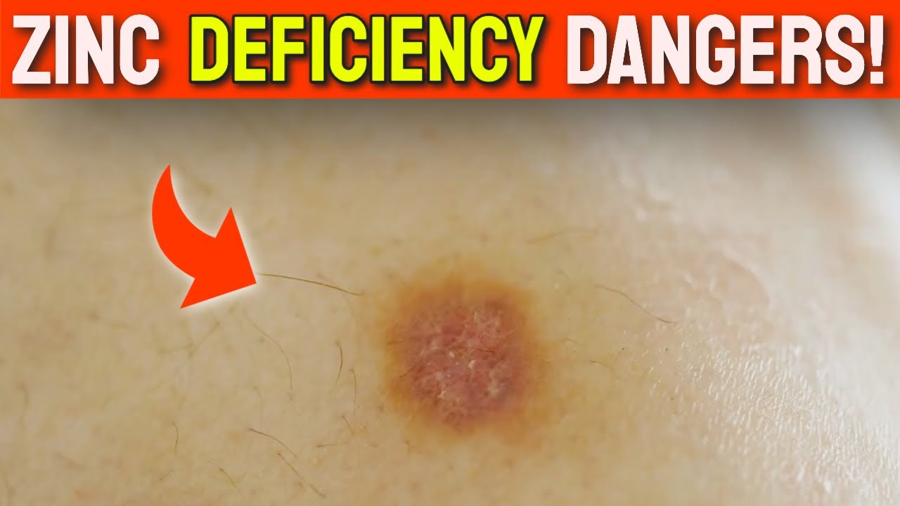 Warning Signs of Zinc Deficiency and How to Fix It & Best Benefits of ...