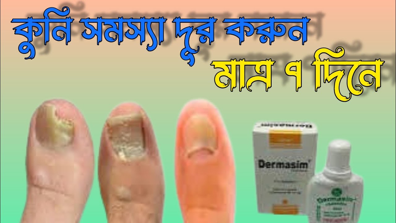 Dermasim এর কাজ কি| নখের কুনি সমস্যা থেকে মুক্তির উপায়| - YouTube