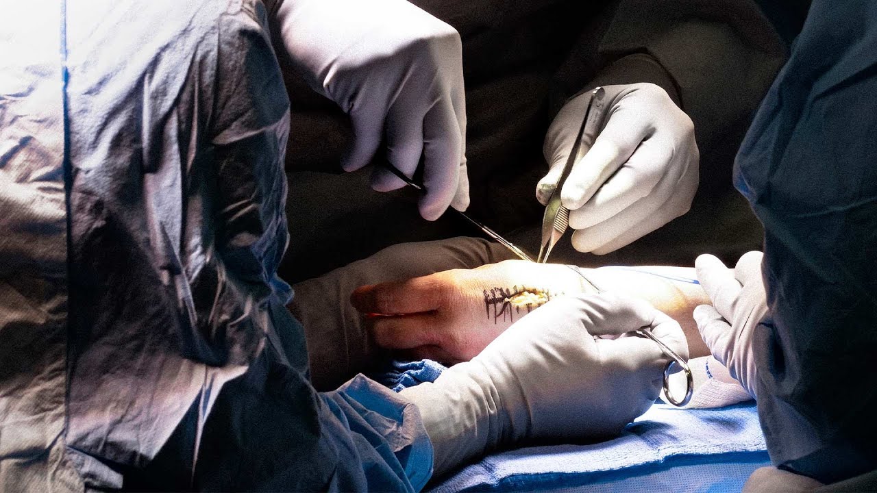 Needle Aponeurotomy for Dupuytren's Contracture by Sanj Kakar, MD, FAOA ...