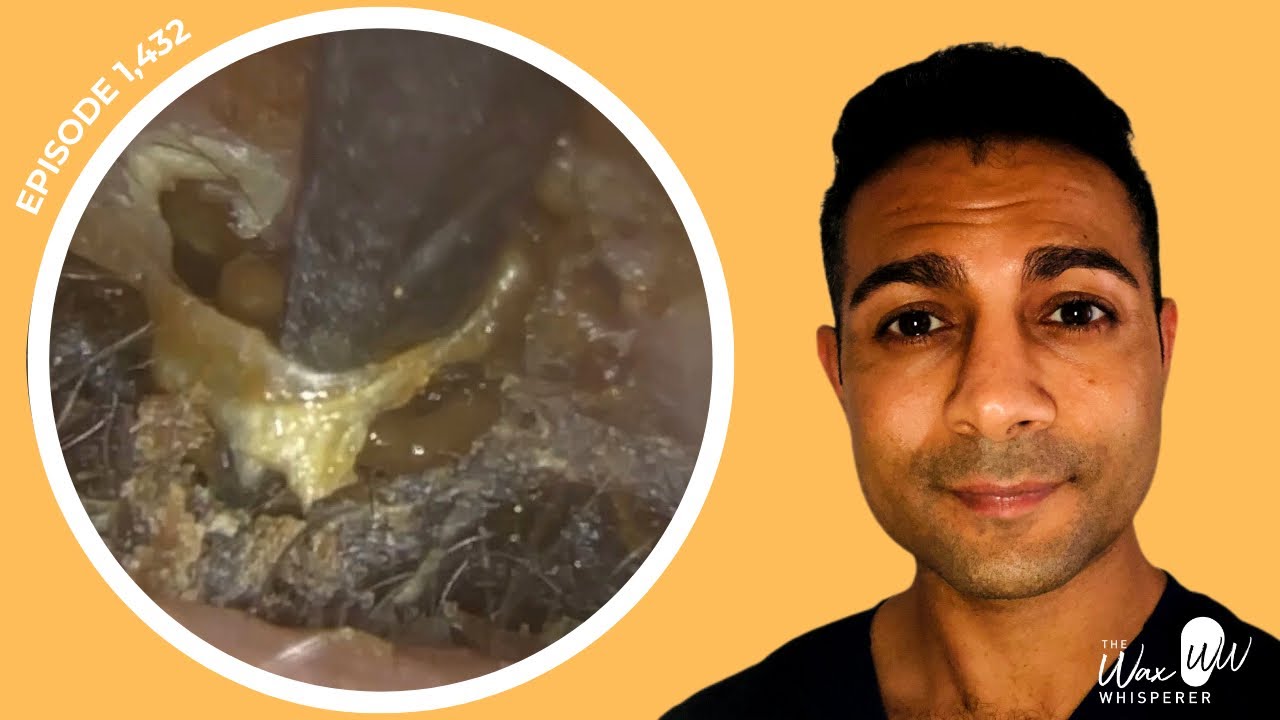 1,432 - Possible Rare Canal Cholesteotoma Discovered Behind Ear Wax ...