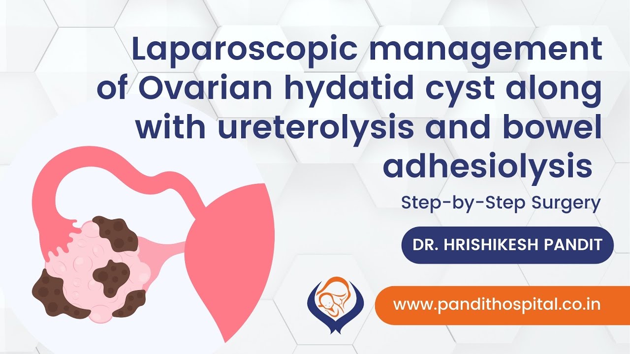 Laparoscopic management of Ovarian hydatid cyst along with ureterolysis ...