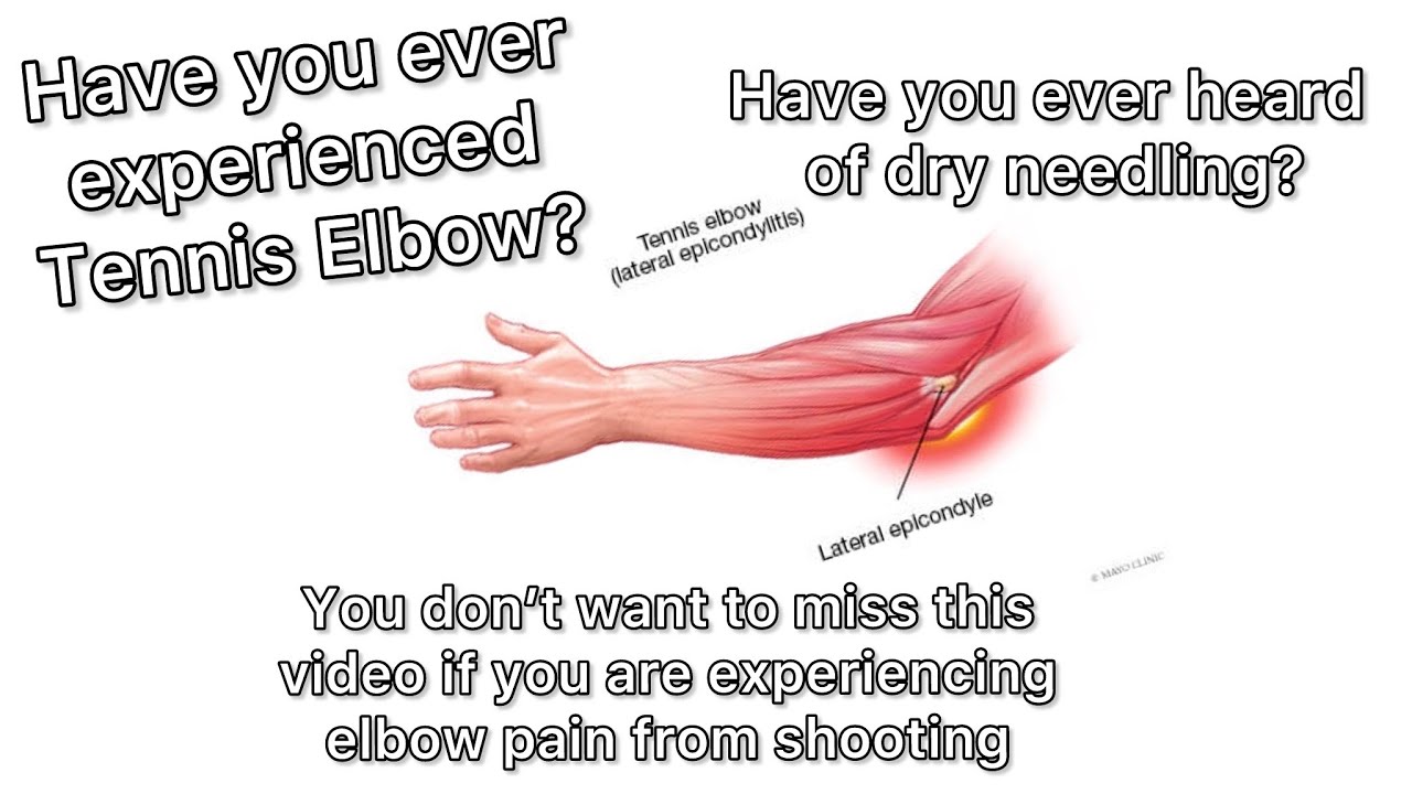 Dry Needling Tennis Elbow - YouTube