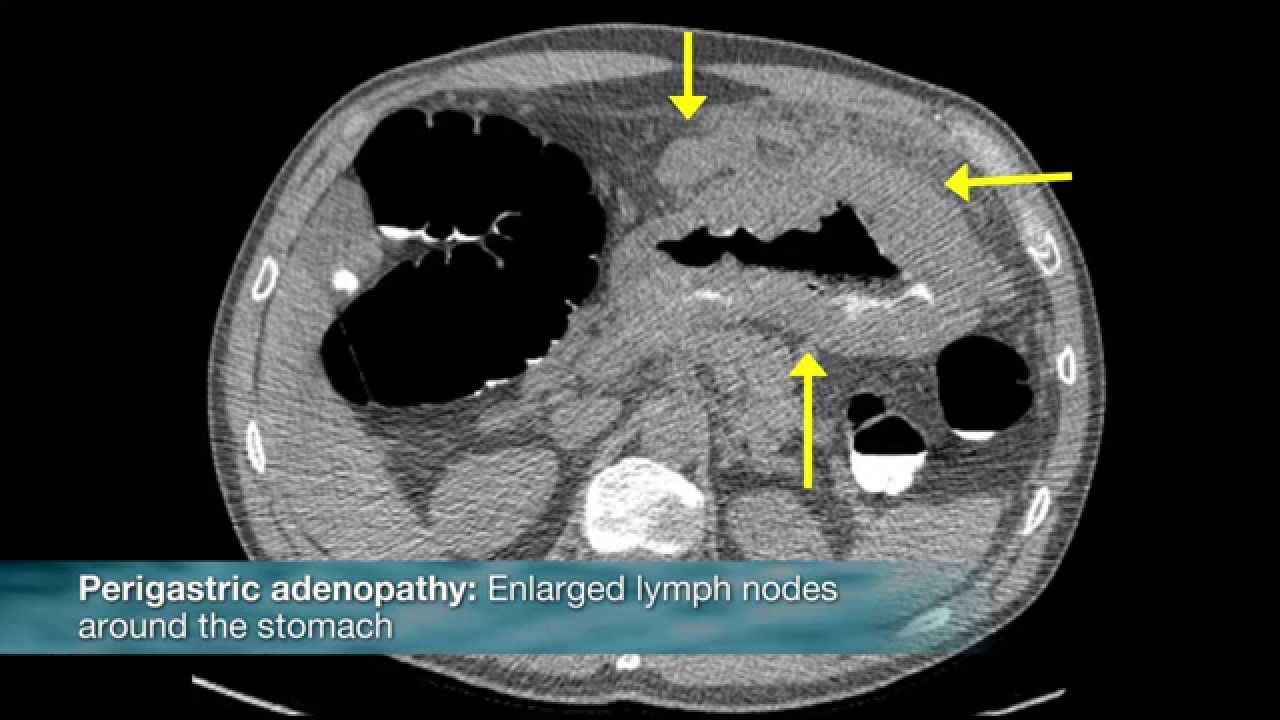UCSF Radiology: Findings Outside The Colon - YouTube