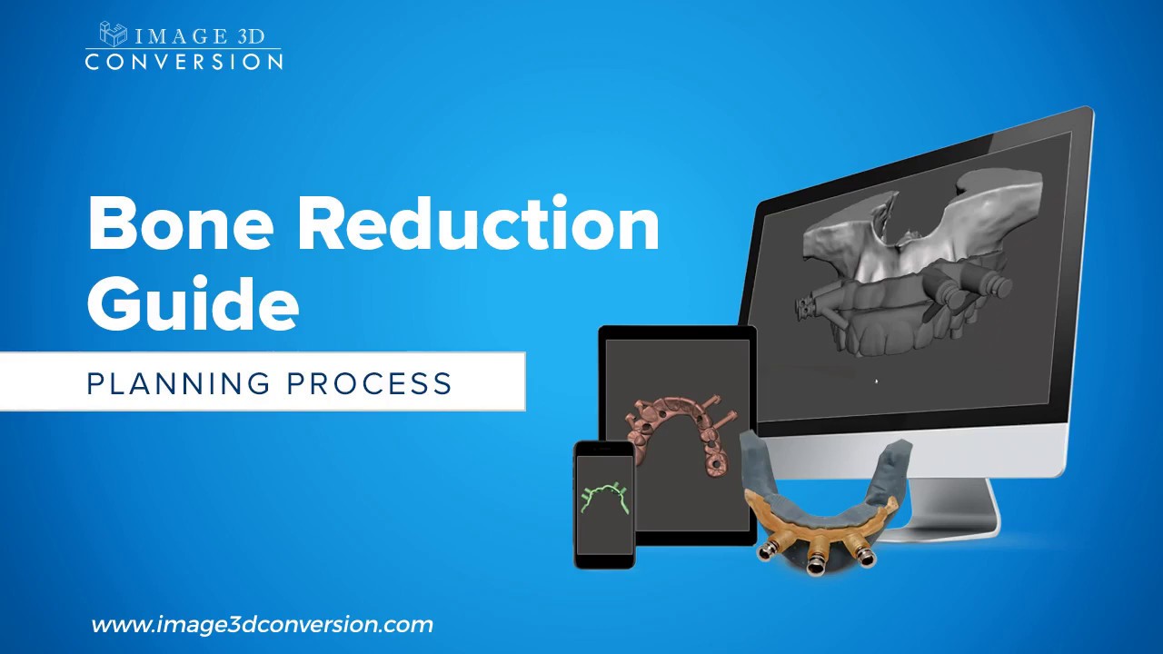 Bone Reduction Guide, Implant Guide Mock-up with Temporary Prosthesis ...