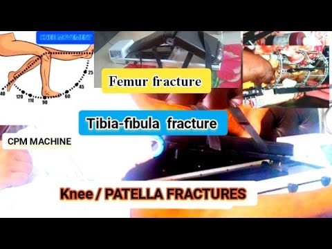 How to Use the CPM ( Continuous Passive Motion Machine ) KNEE BEST ...