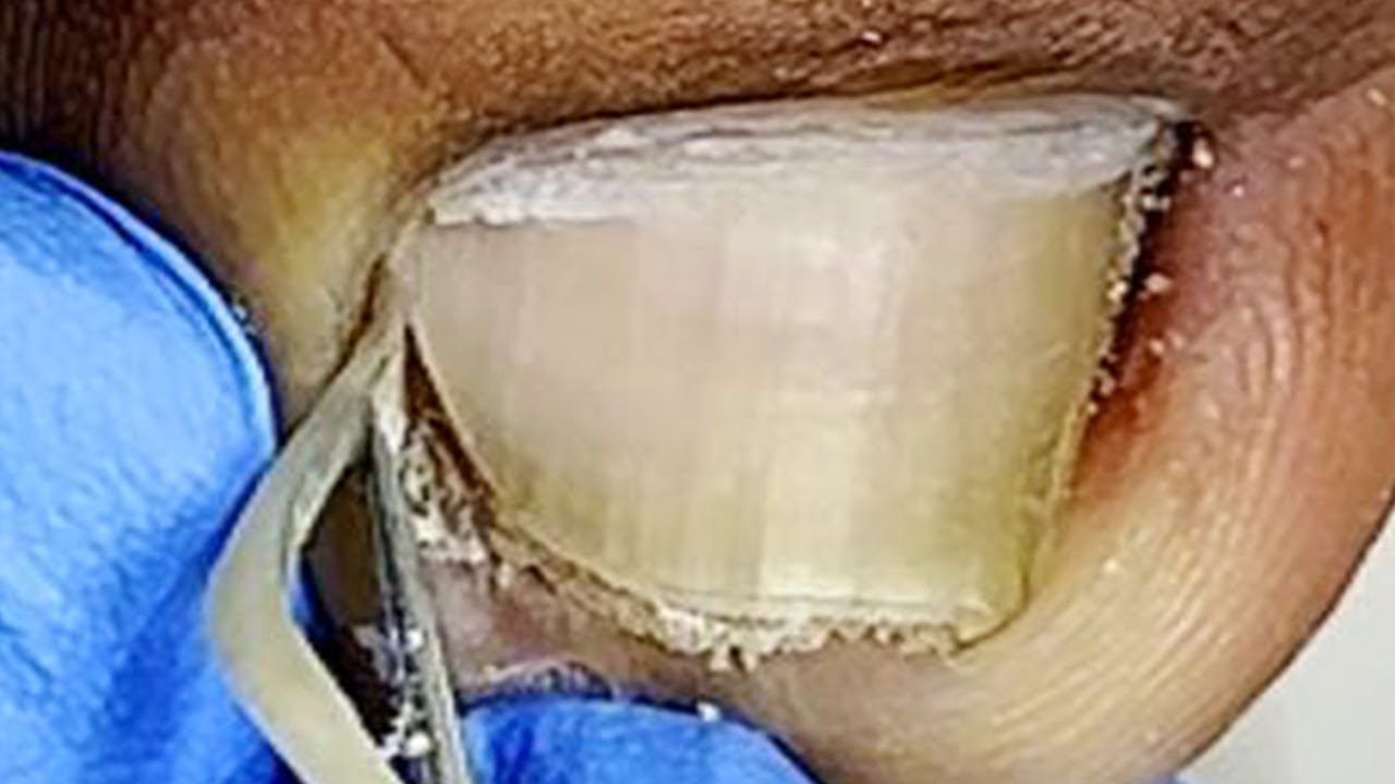 The nail inlay is very deep! Carefully dig out - YouTube