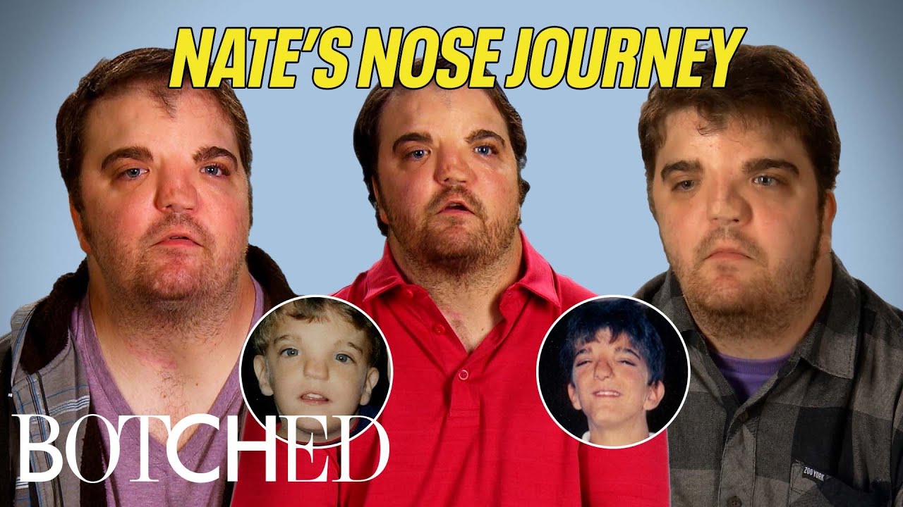 From Two Noses to Normal: Nate's Five-Year Journey with Dr. Nassif ...