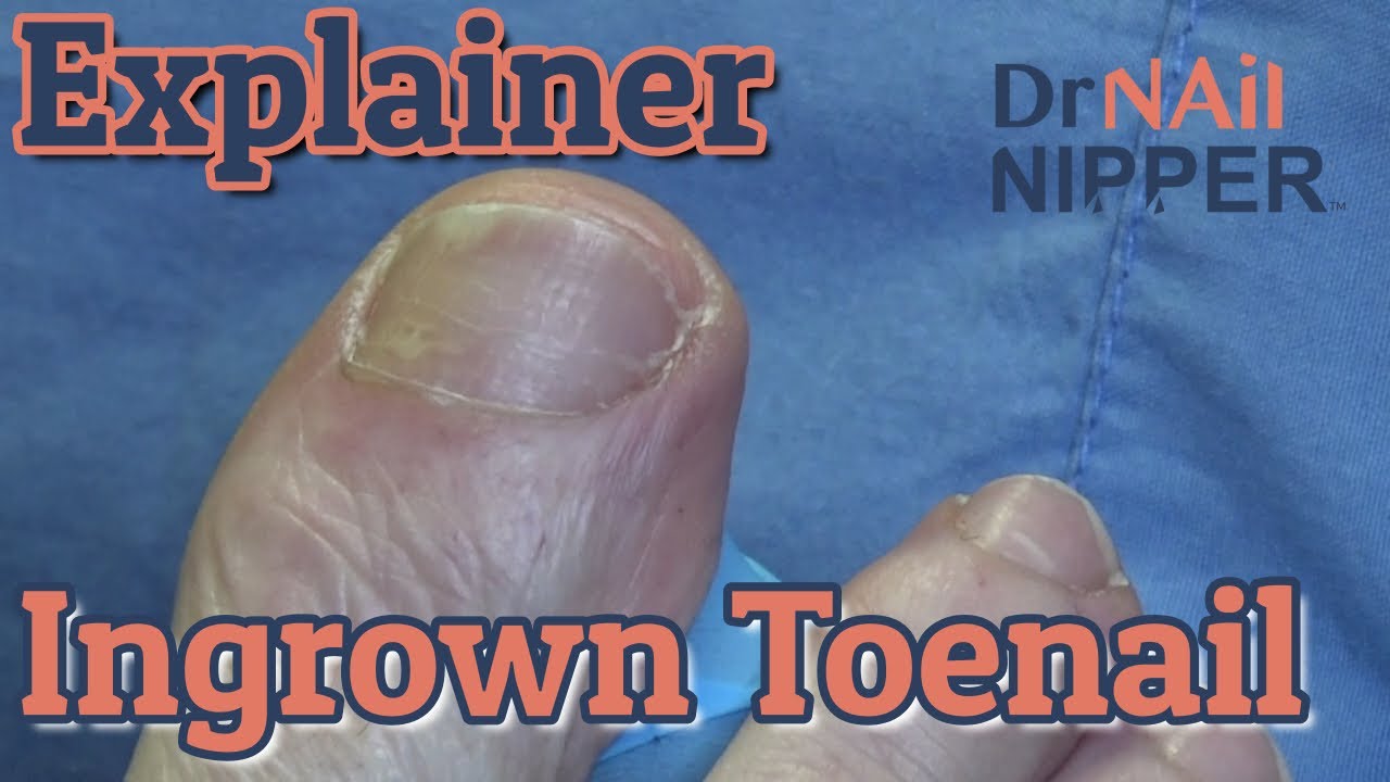 Dr Nail Nipper Explains Ingrown Toenails [Callus Tuesday] (2020) - YouTube