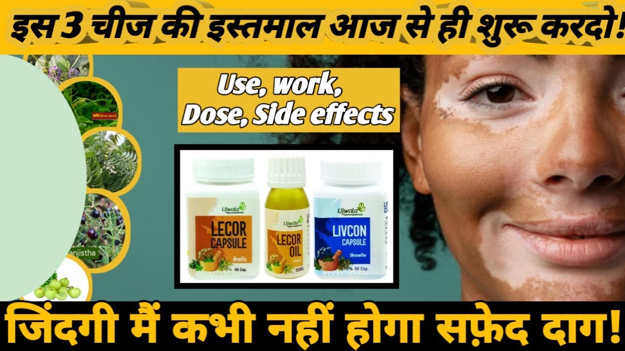Lecor capsule/Lecor oil use in Hindi //Vitiligo ko kese thik kare ...