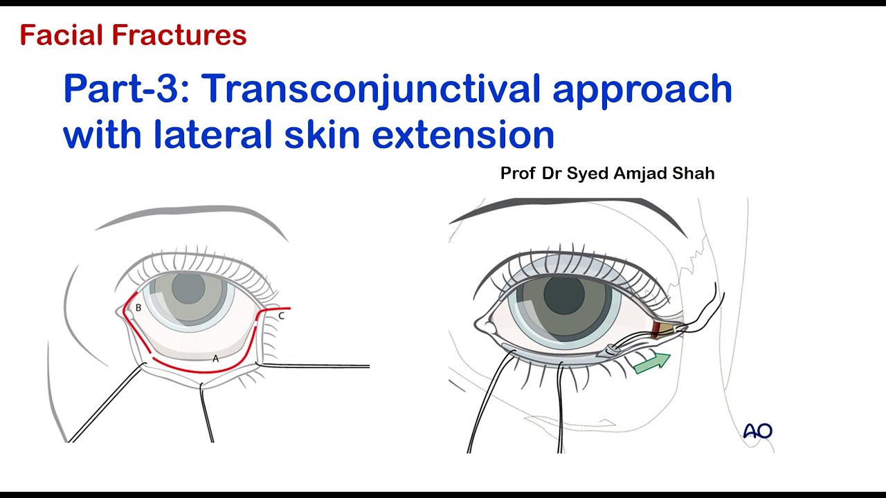 Transconjunctival approach with Lateral Skin Extension | Part 3 | Syed ...