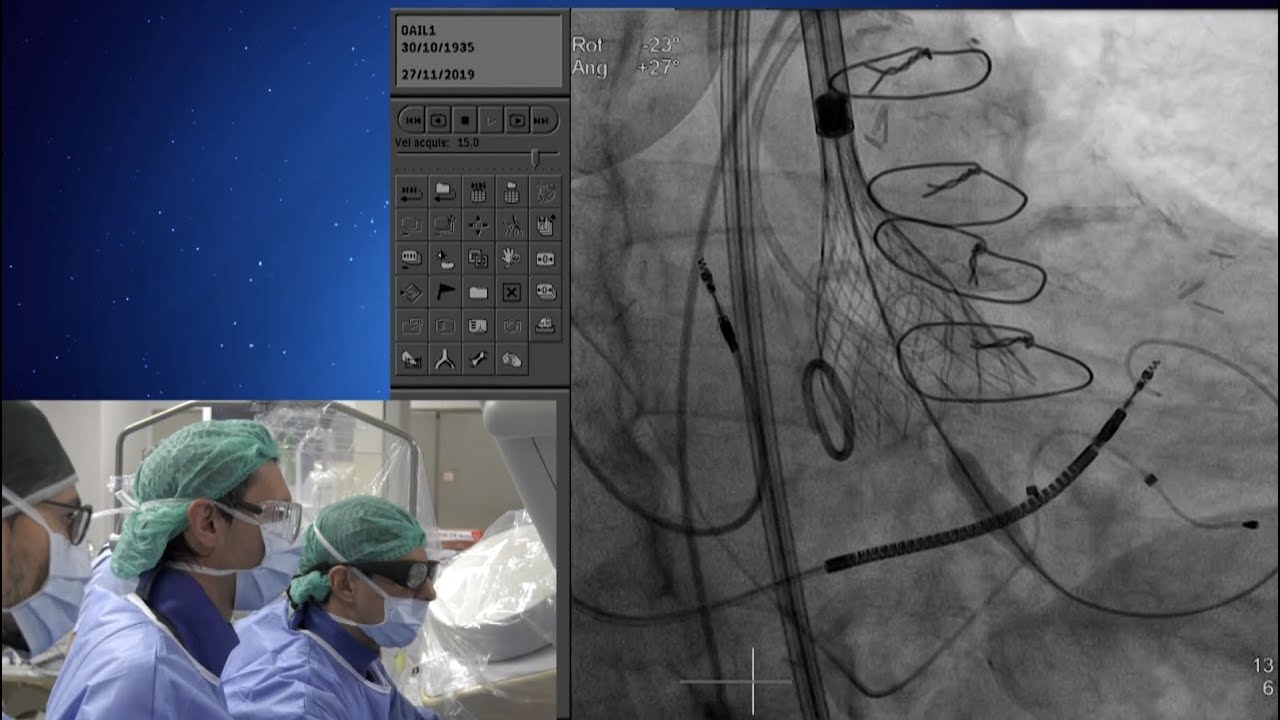 LIVE IN THE BOX: SELF-EXPANDABLE TAVI - YouTube