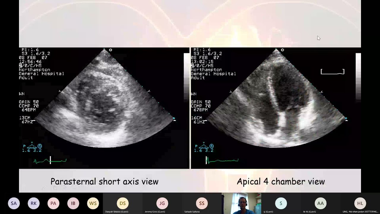 21 06 04 Echocardiogram Interpretation YouTube 21-06-04-echocardiogram-interpretation-youtube