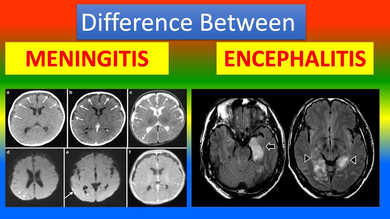 Difference Between Meningitis and Encephalitis - YouTube