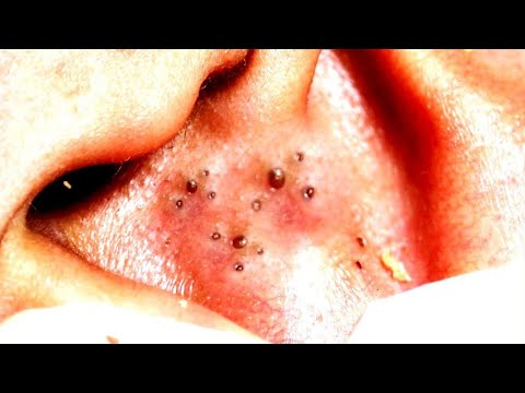 A satisfying video about pimples for true Popaholics! 🤯🔴 - YouTube