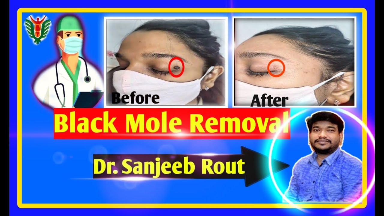 Black Mole Removal || Dr. Sanjeeb Rout || Balaji Superspecialty Clinic - YouTube