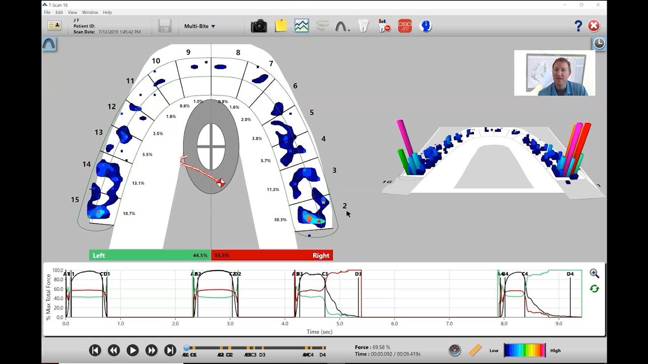 How to Analyze Bite Timing with T-Scan - YouTube