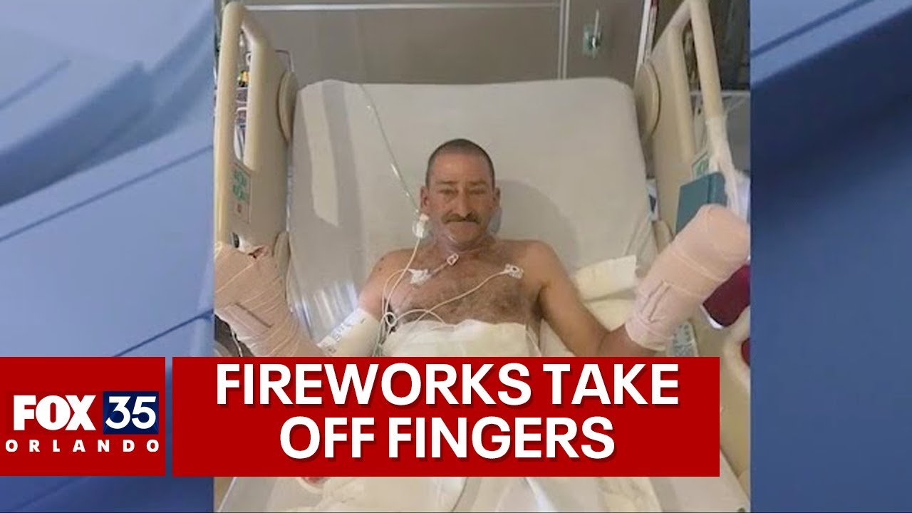 Florida man loses most of his fingers in fireworks explosion - YouTube