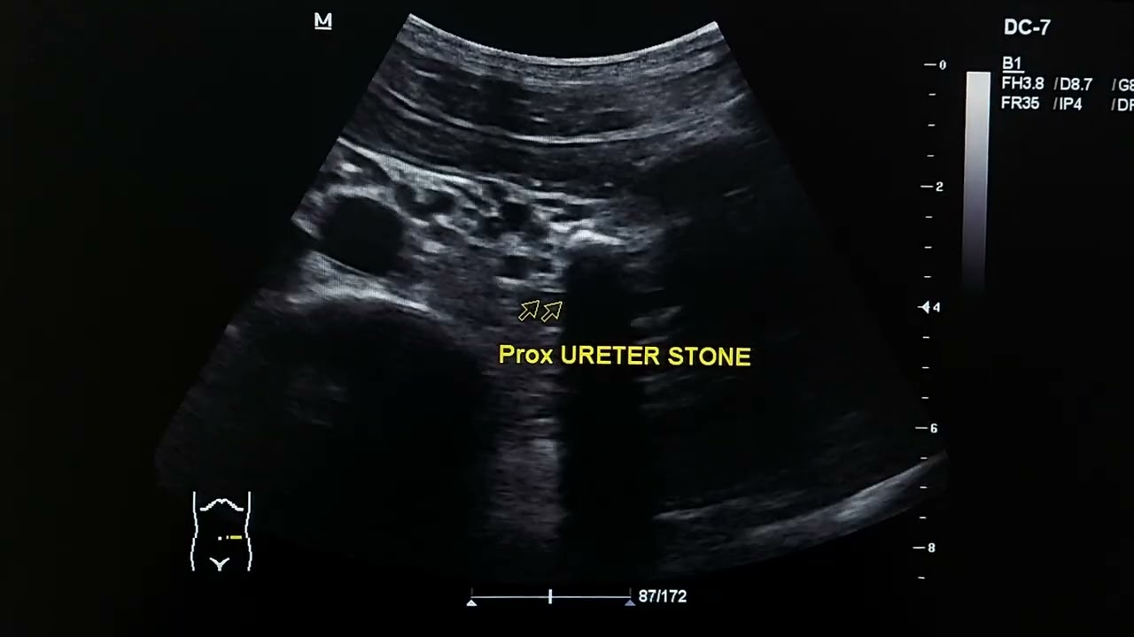 severe chronic hydronephrosis due to a neglected upper ureter stone ...