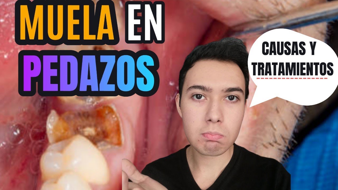 ¿Por que las muelas se caen en pedazos? / Mi muela esta floja y me ...