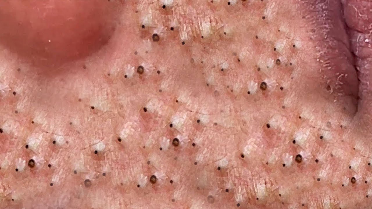 Make your Acne Treatment | Acne spa 377 | Acne spa Treatment - YouTube