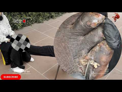 JIM RUS JIGGER REMOVAL - Extreme Jigger Nest – Crawling Under Skin ...