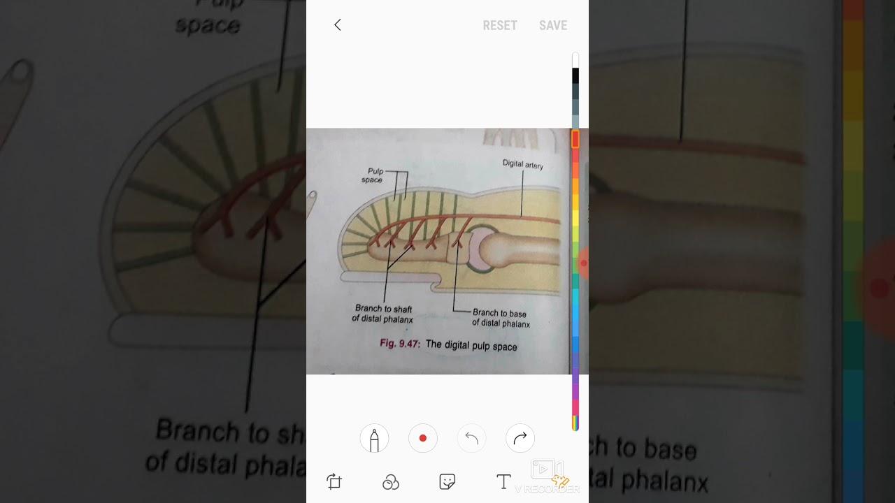 Pulp space of finger, surgical spaces of hand. - YouTube