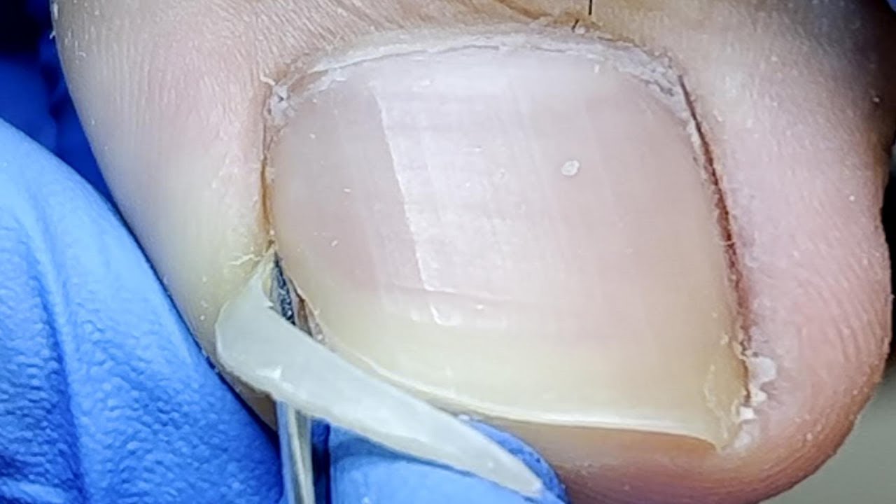 Very clean toenails, trimmed and contoured【Xue Yidao Pedicure】 - YouTube