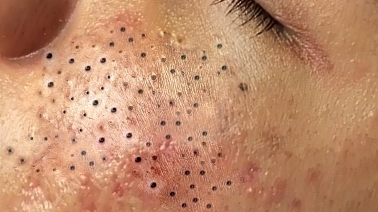 𝐄𝐱𝐭𝐫𝐞𝐦𝐞 𝐁𝐥𝐚𝐜𝐤𝐡𝐞𝐚𝐝 𝐑𝐞𝐦𝐨𝐯𝐚𝐥 𝐚𝐭 𝐋𝐍𝐆 𝐒𝐤𝐢𝐧 𝐂𝐚𝐫𝐞 # 423195 - YouTube