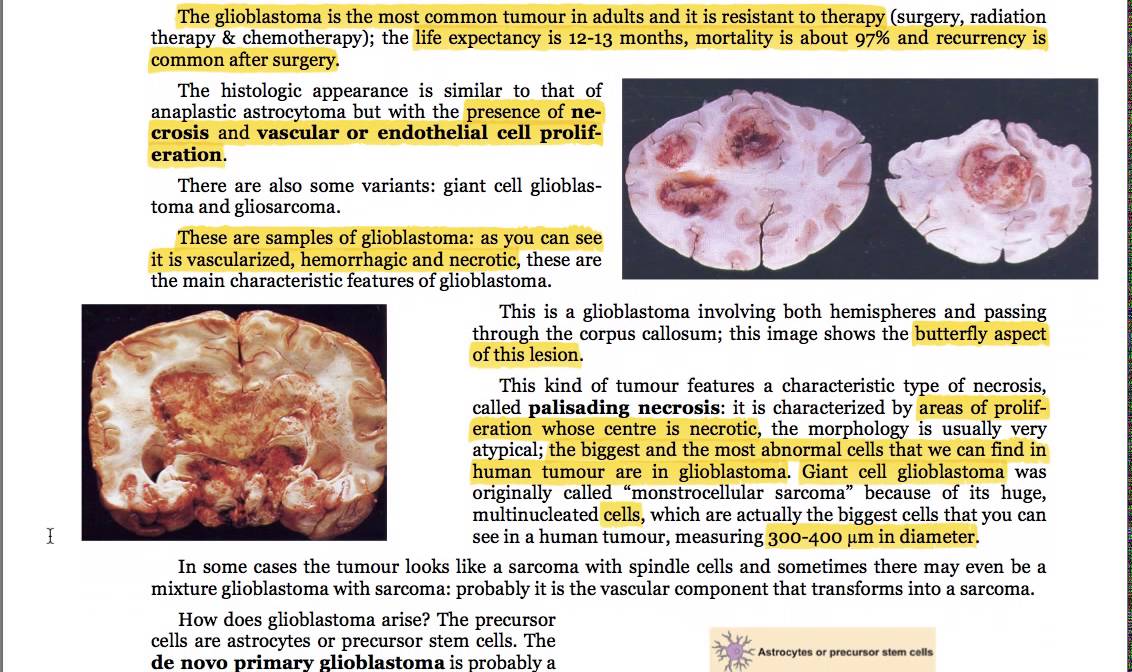 CNS pathology - YouTube
