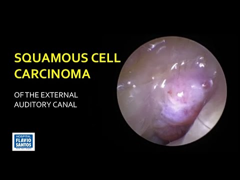 SQUAMOUS CELL CARCINOMA OF THE EXTERNAL AUDITORY CANAL - YouTube